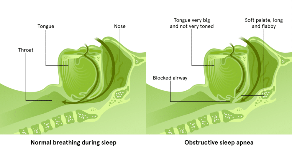 Reclaim Your Nights: Simple Sleep Apnea Exercises to Improve Airflow ...