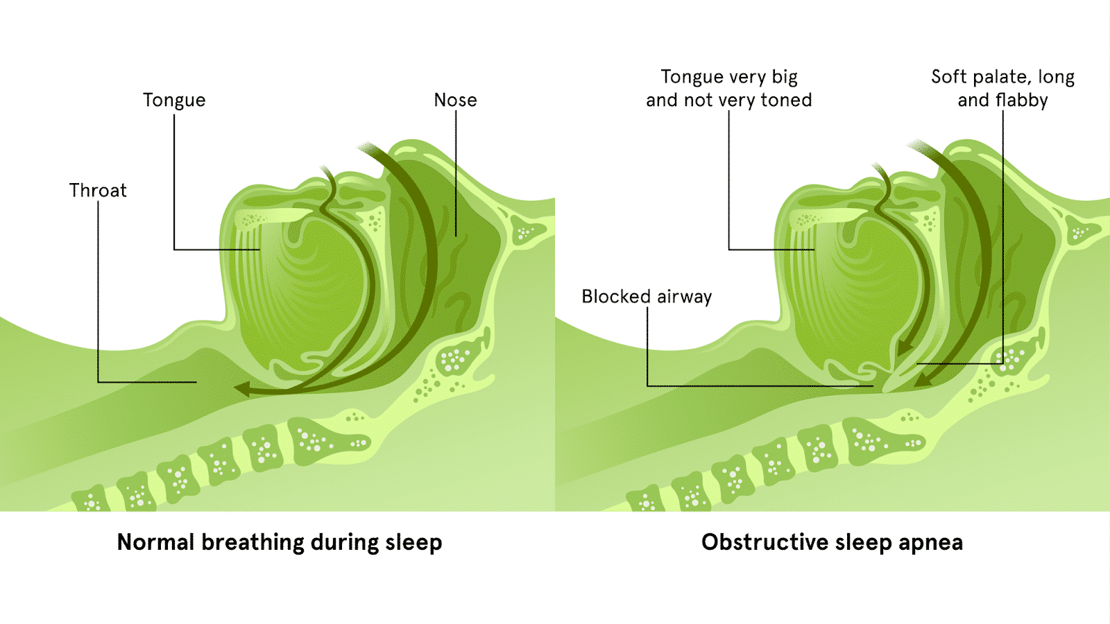 Reclaim Your Nights: Simple Sleep Apnea Exercises to Improve Airflow ...