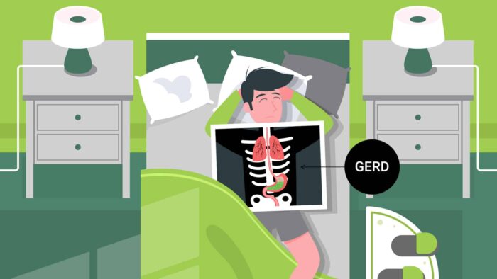 Does Sleeping Sitting Up Help Sleep Apnea? Exploring Potential Benefits ...